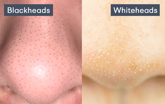 blackheads & whiteheads – The UNS India